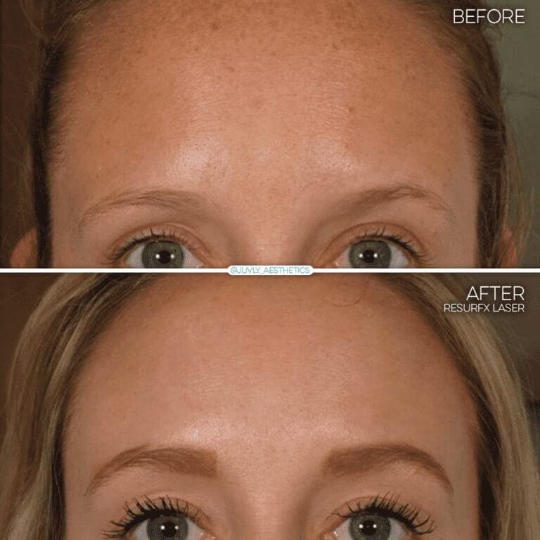 Juvly Aesthetics: ResurFx Laser For Skin Resurfacing
