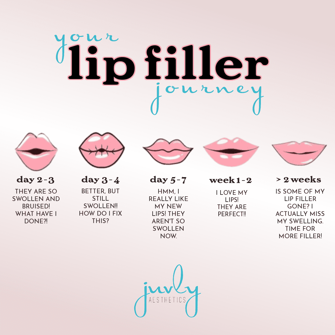 Juvly Aesthetics: Lip Injections For Natural Well-Defined Plump Lips