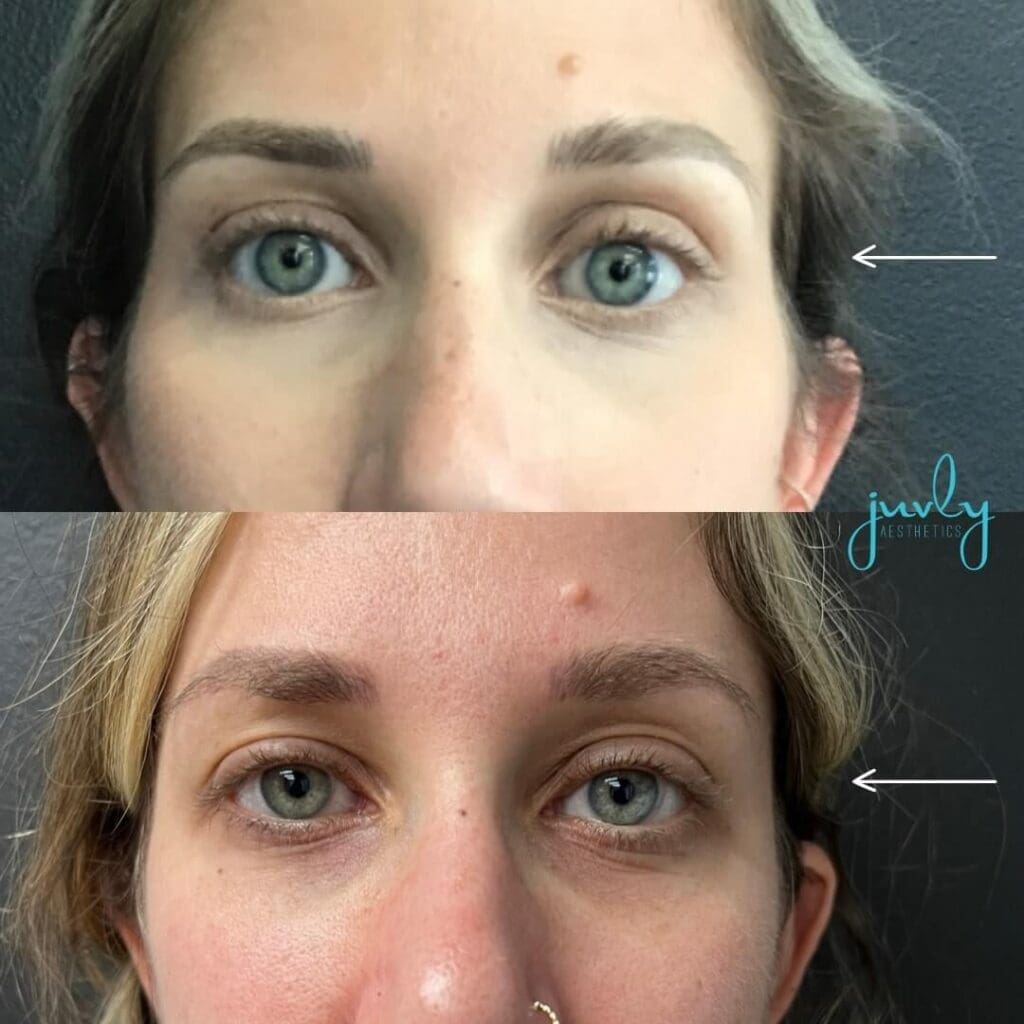 Juvly Aesthetics Gallery - Sculptra Temple Filler - Juvly Aesthetics